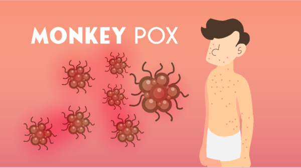 Luxembourg Confirms Case of Monkeypox in Toddler